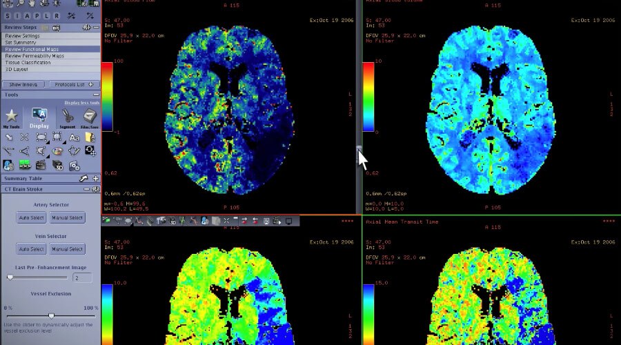 CT Perfusion 4D Multi-Organ | GE Healthcare